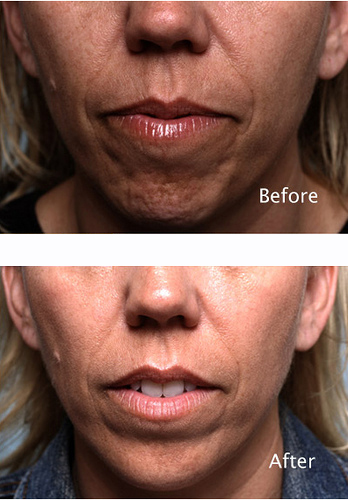 Orange peel chin | PERFECT FACE | Facial LASER Aesthetics Clinic ...
