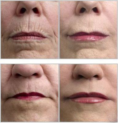 Lipstick or Bar Code Lines | PERFECT FACE | Facial LASER Aesthetics ...